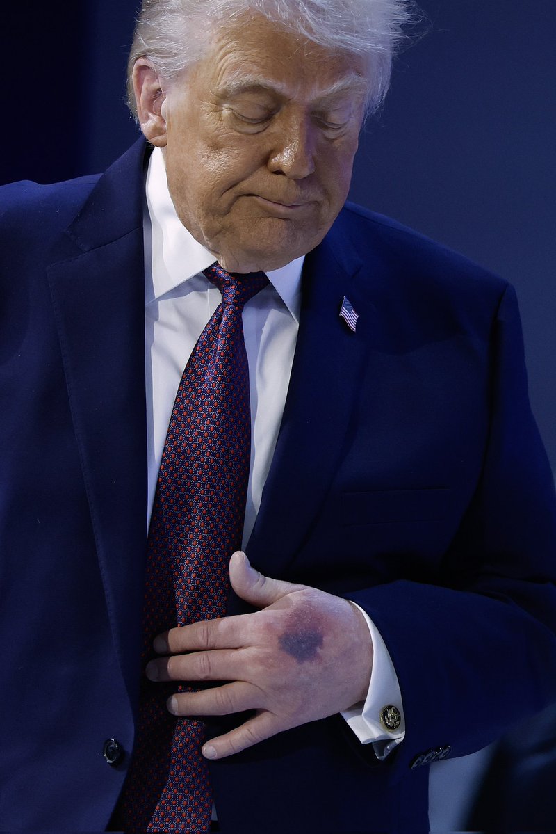 🇺🇸 | Donald Trump sobre el moretón en su mano: «Estoy muy bien. Me ...